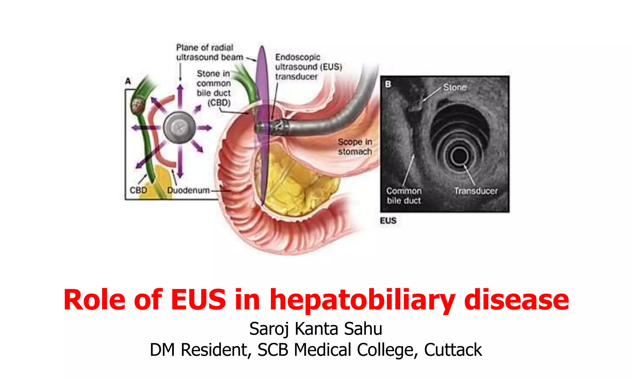 Role of EUS in hepatobiliary diseases | PPTX