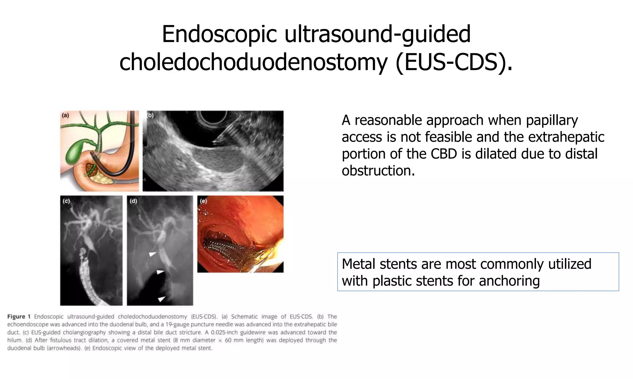 Role of EUS in hepatobiliary diseases | PPTX