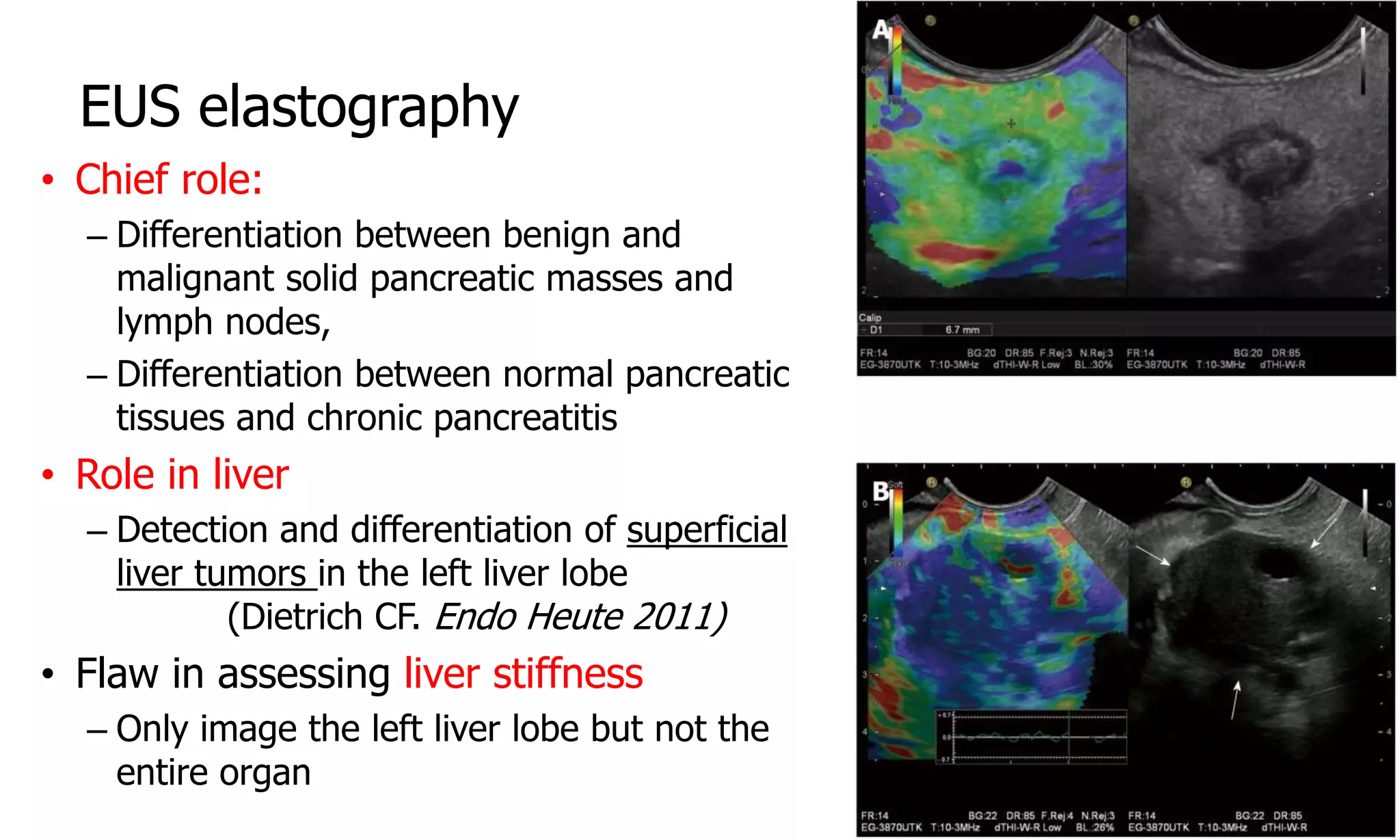 Role of EUS in hepatobiliary diseases | PPTX