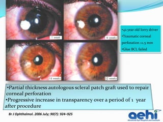 Role of Eye Bank beyond Cornea - Sclera | PPTX
