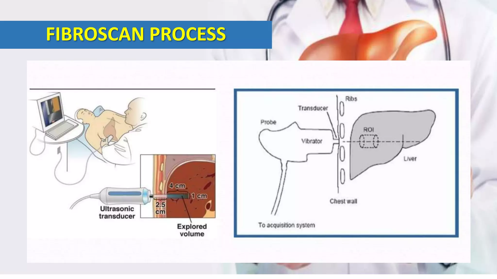 Role of Fibroscan in Liver Disease Ppt | PPTX