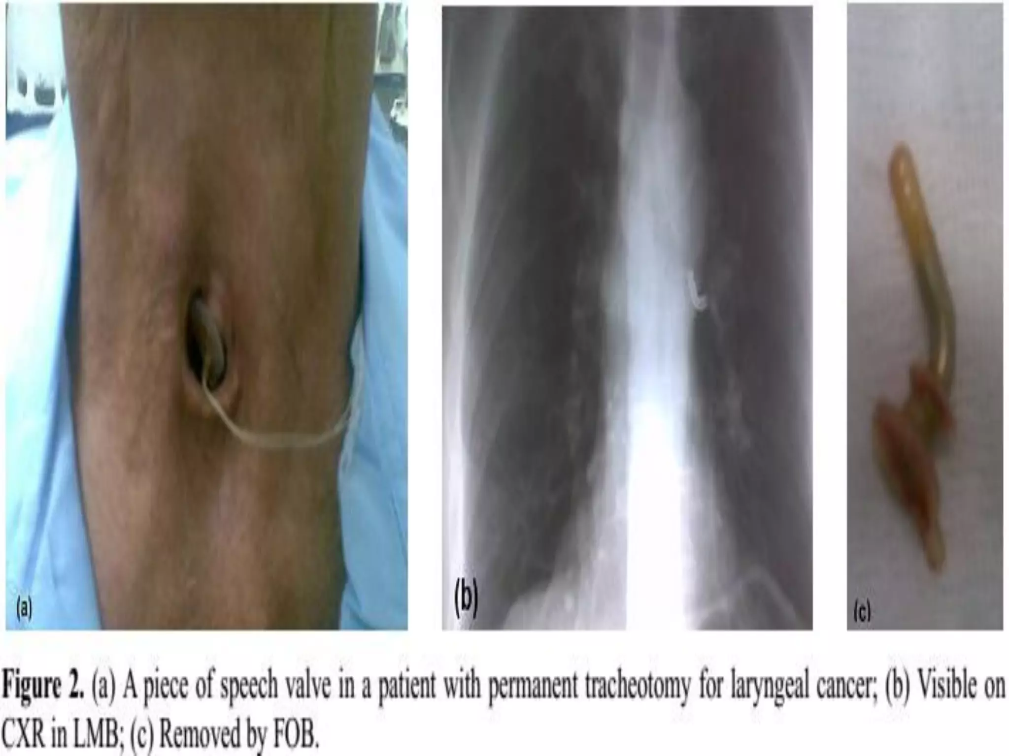 Role of fob in FB extraction | PPT