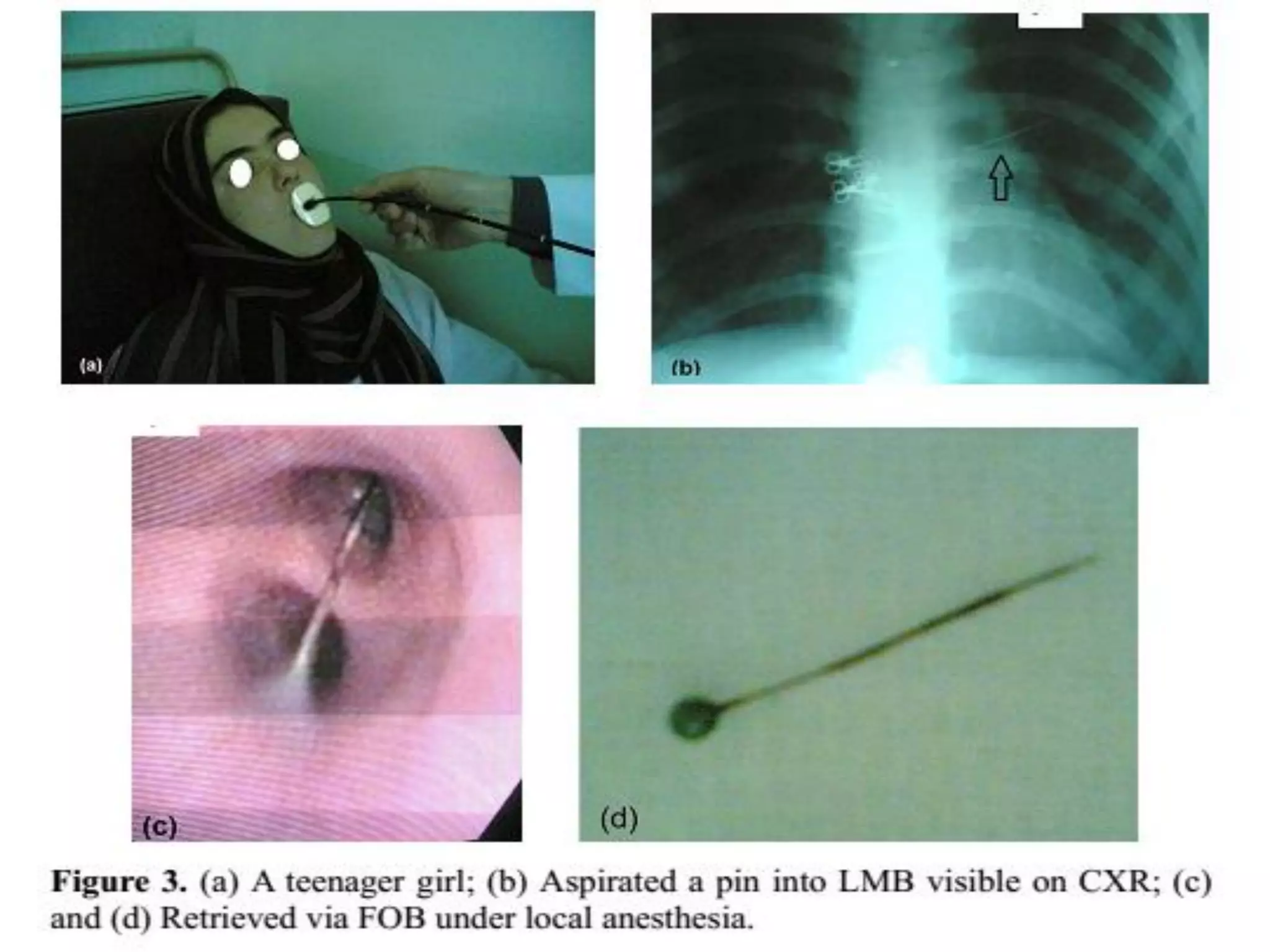 Role of fob in FB extraction | PDF