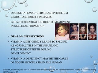role of harmones and vitamins in craniofacial growth and development | PPTX