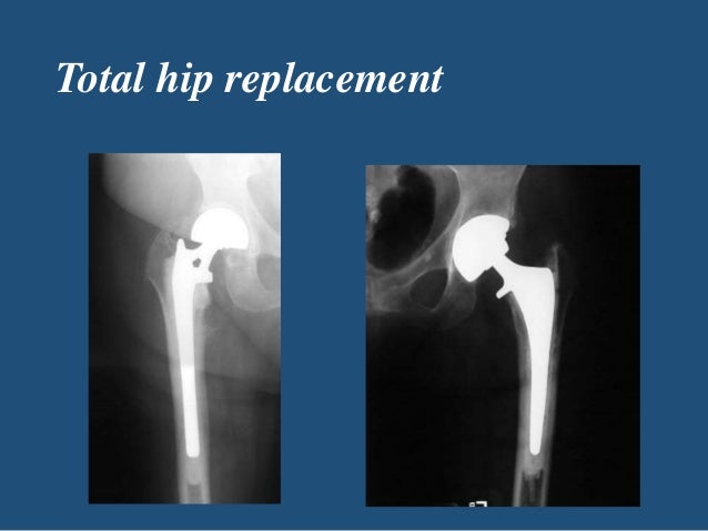 Role of hemiarthroplasty -30th aug 2015