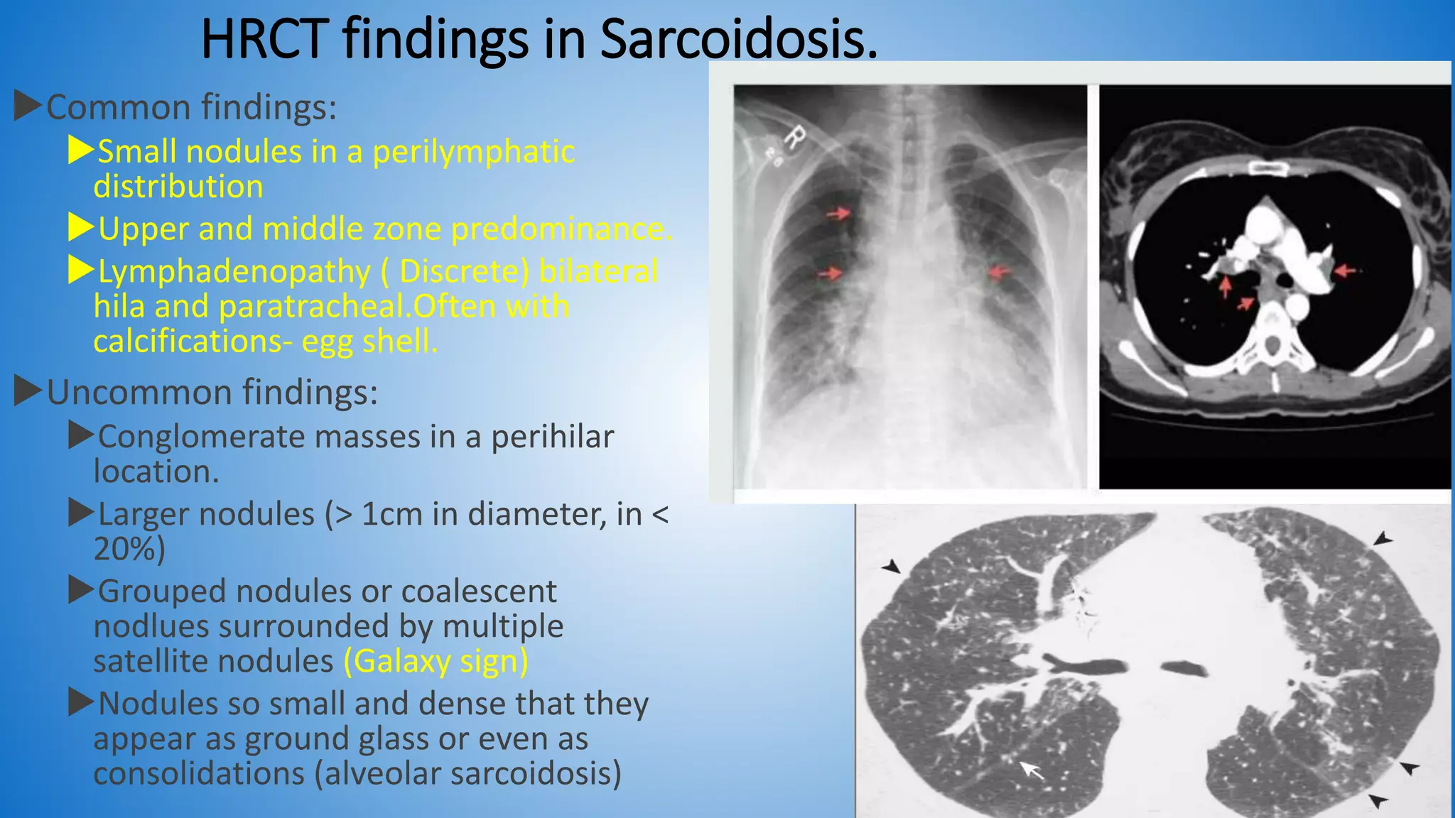 Role of hrct in interstitial lung diseases pk upload | PPTX