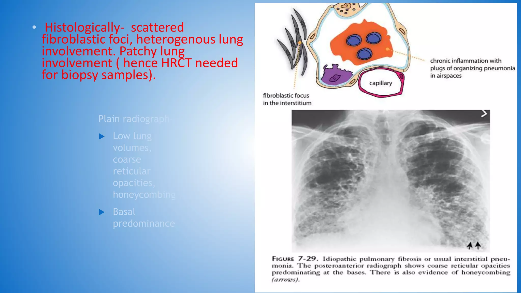 Role of hrct in interstitial lung diseases pk upload | PPTX