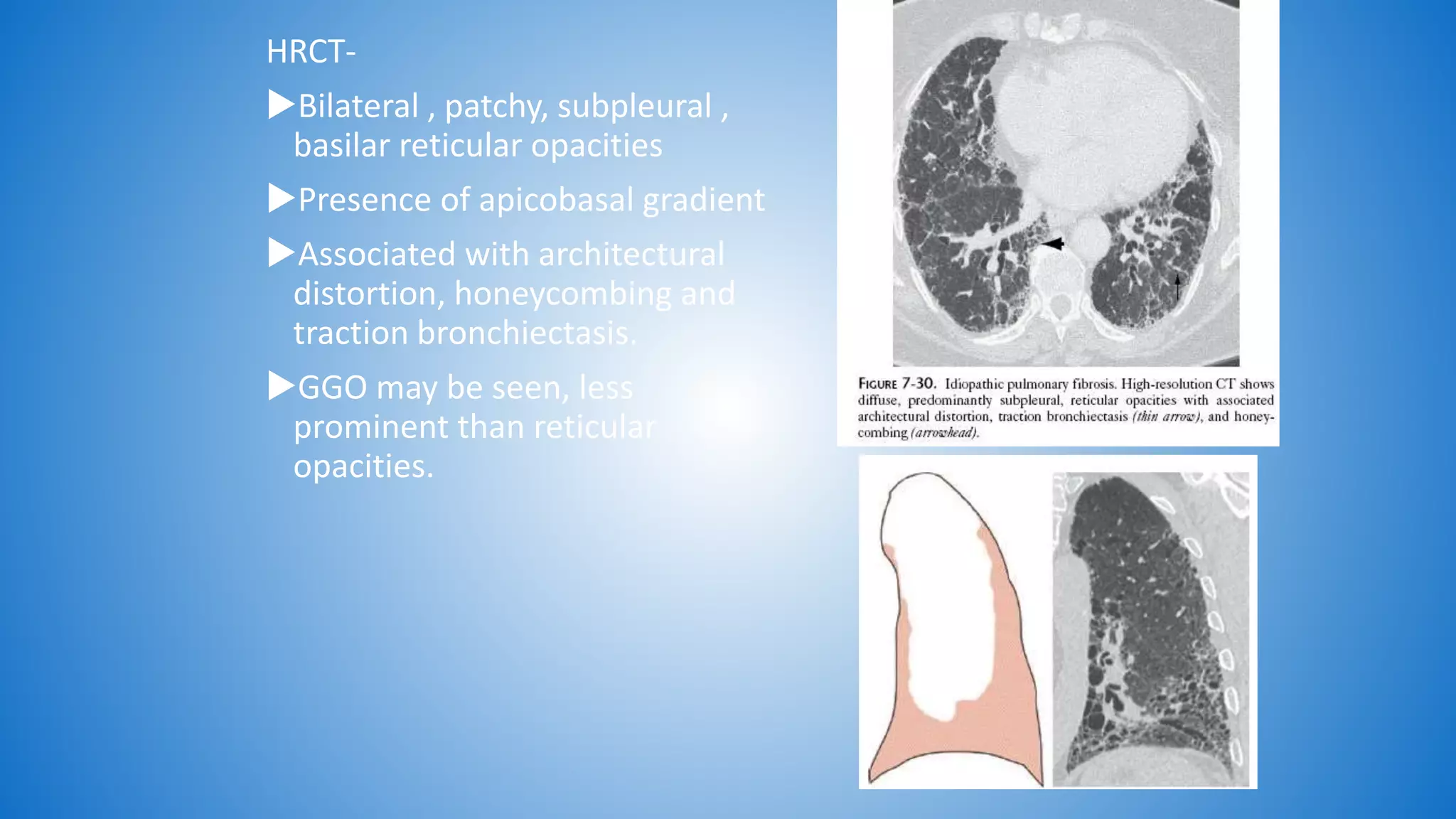 Role of hrct in interstitial lung diseases pk upload | PPTX
