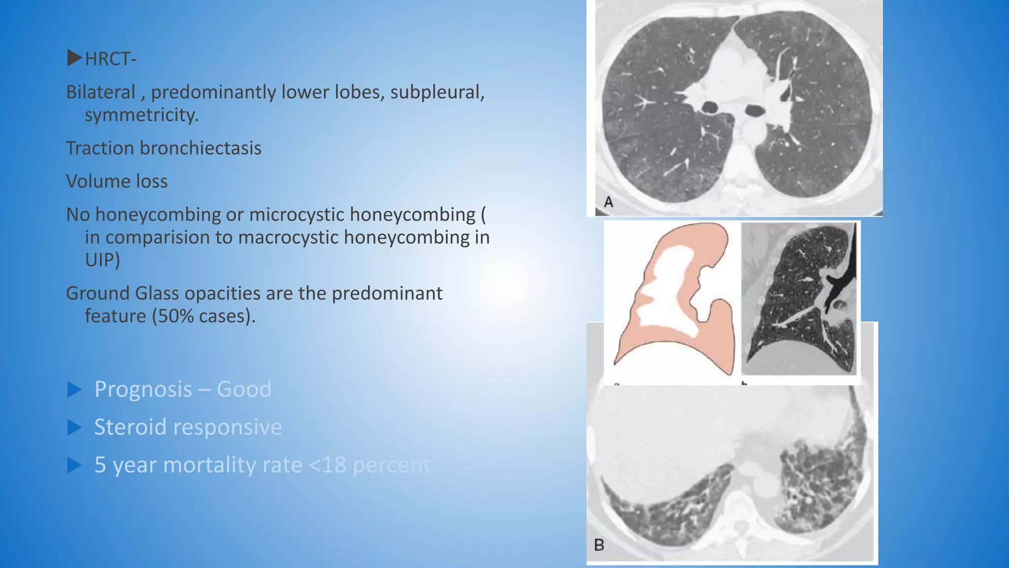 Role of hrct in interstitial lung diseases pk upload | PPTX