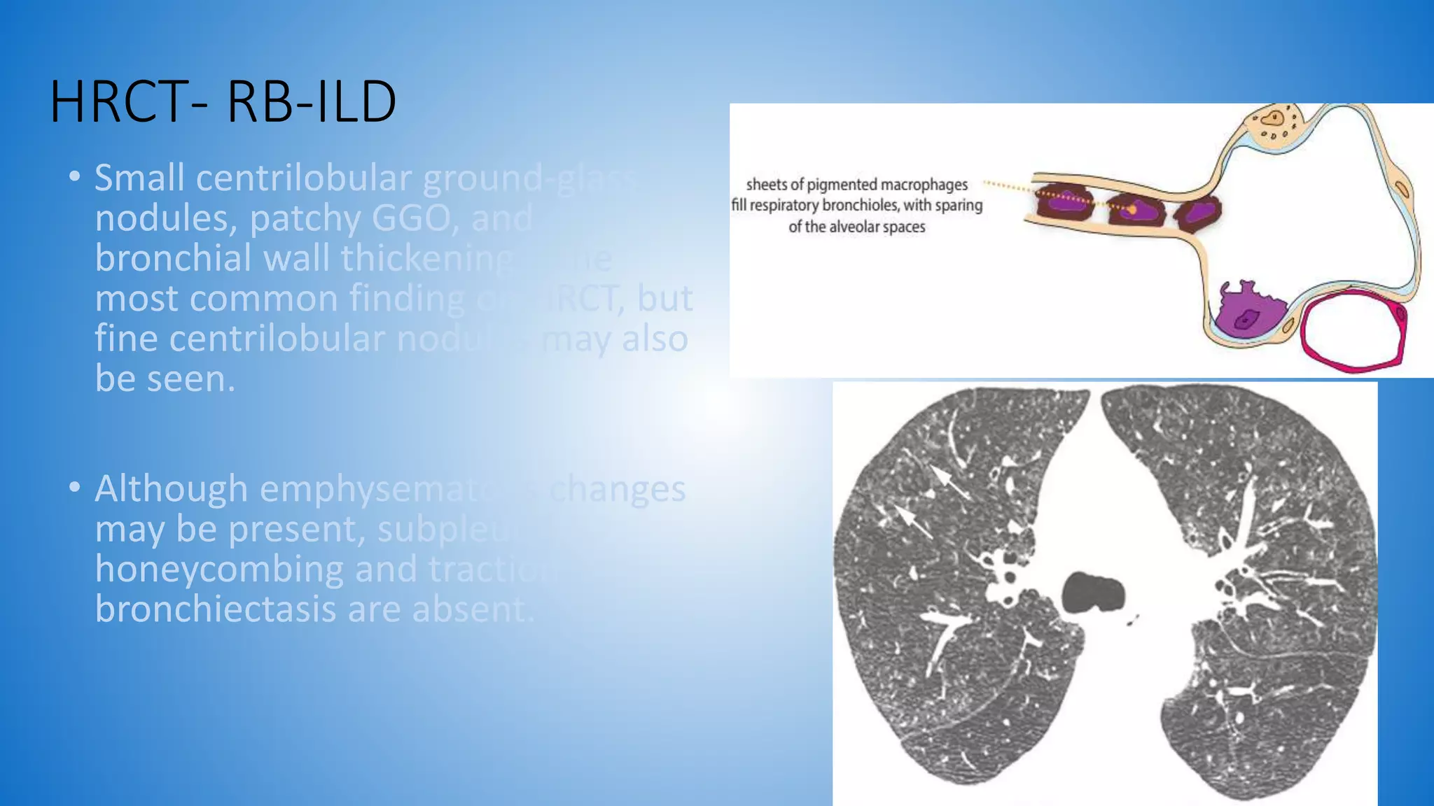 Role of hrct in interstitial lung diseases pk upload | PPTX