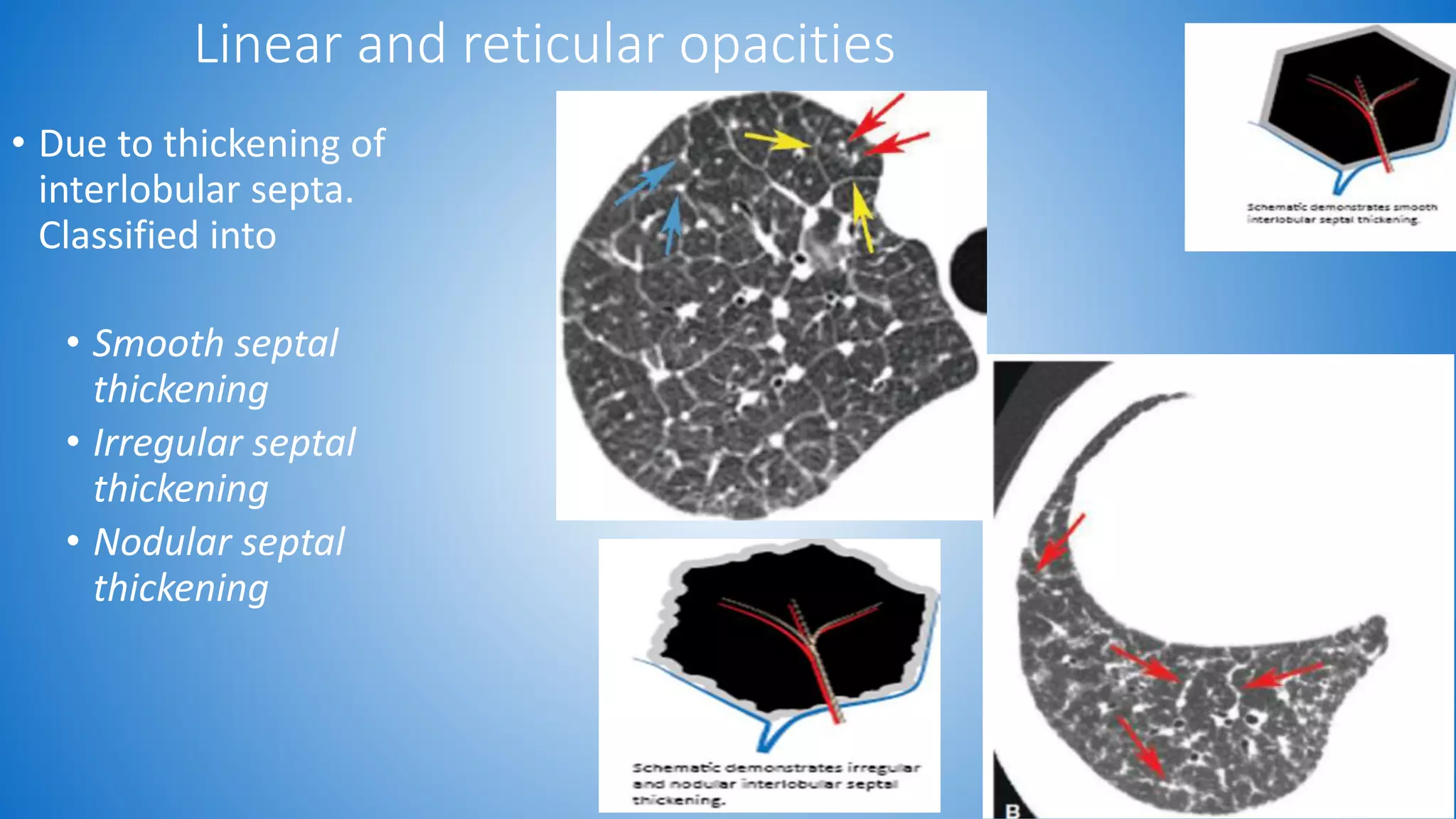 Role of hrct in interstitial lung diseases pk upload | PPTX