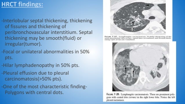Role of hrct in interstitial lung diseases pk upload | PPTX