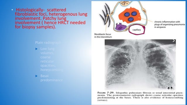 Role of hrct in interstitial lung diseases pk upload | PPTX