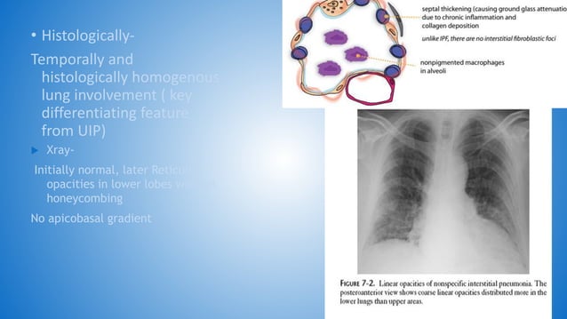 Role of hrct in interstitial lung diseases pk upload | PPTX