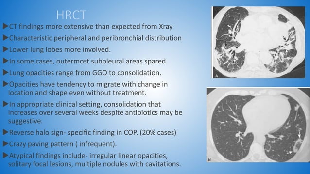 Role of hrct in interstitial lung diseases pk upload | PPTX