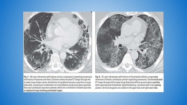 Role of hrct in interstitial lung diseases pk upload | PPTX