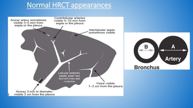 Role of hrct in interstitial lung diseases pk upload | PPTX