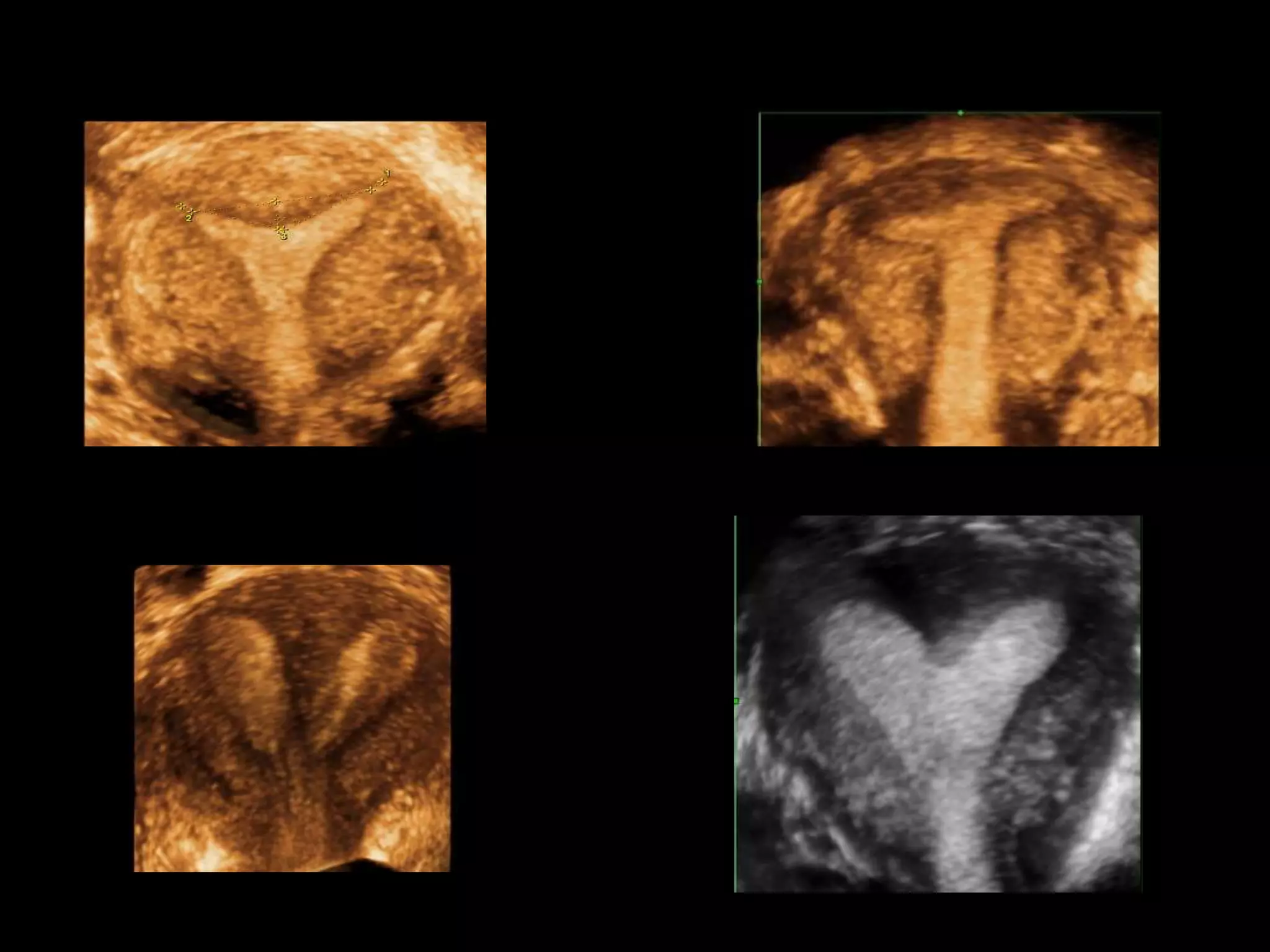 Role Of Hysteroscopy And Laparoscopy In Ivf Ppt