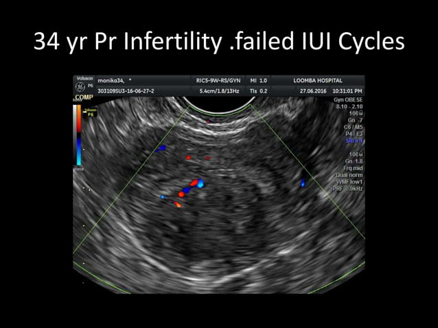 Role of hysteroscopy and laparoscopy in ivf | PPTX