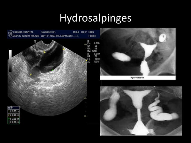 Role of hysteroscopy and laparoscopy in ivf | PPTX