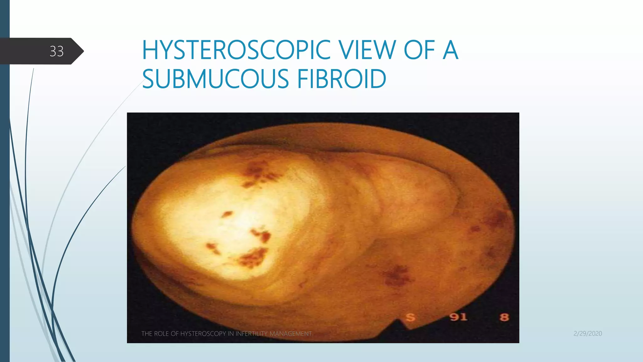 Role of hysteroscopy in infertility Management | PPTX