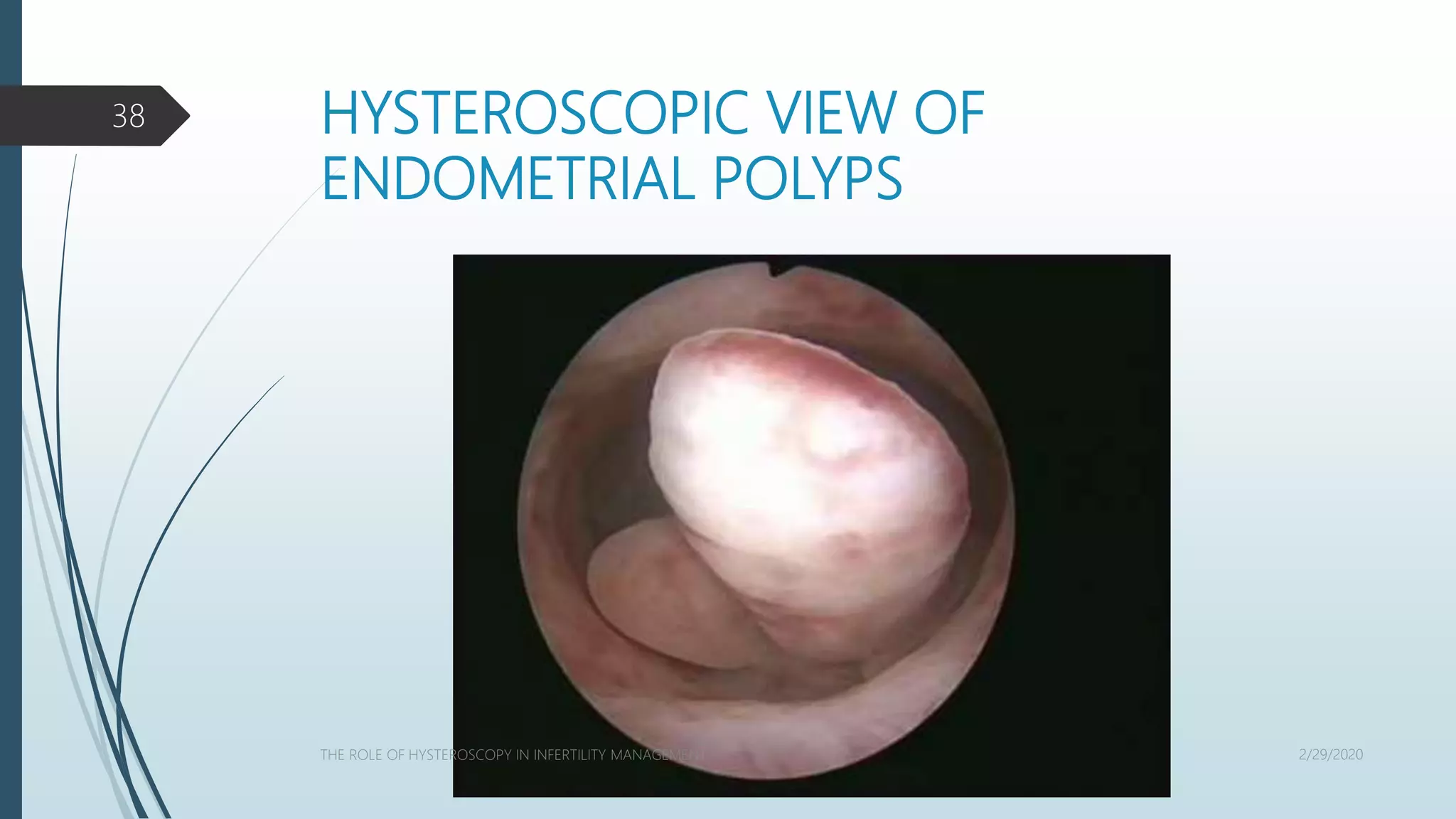 Role of hysteroscopy in infertility Management | PPTX