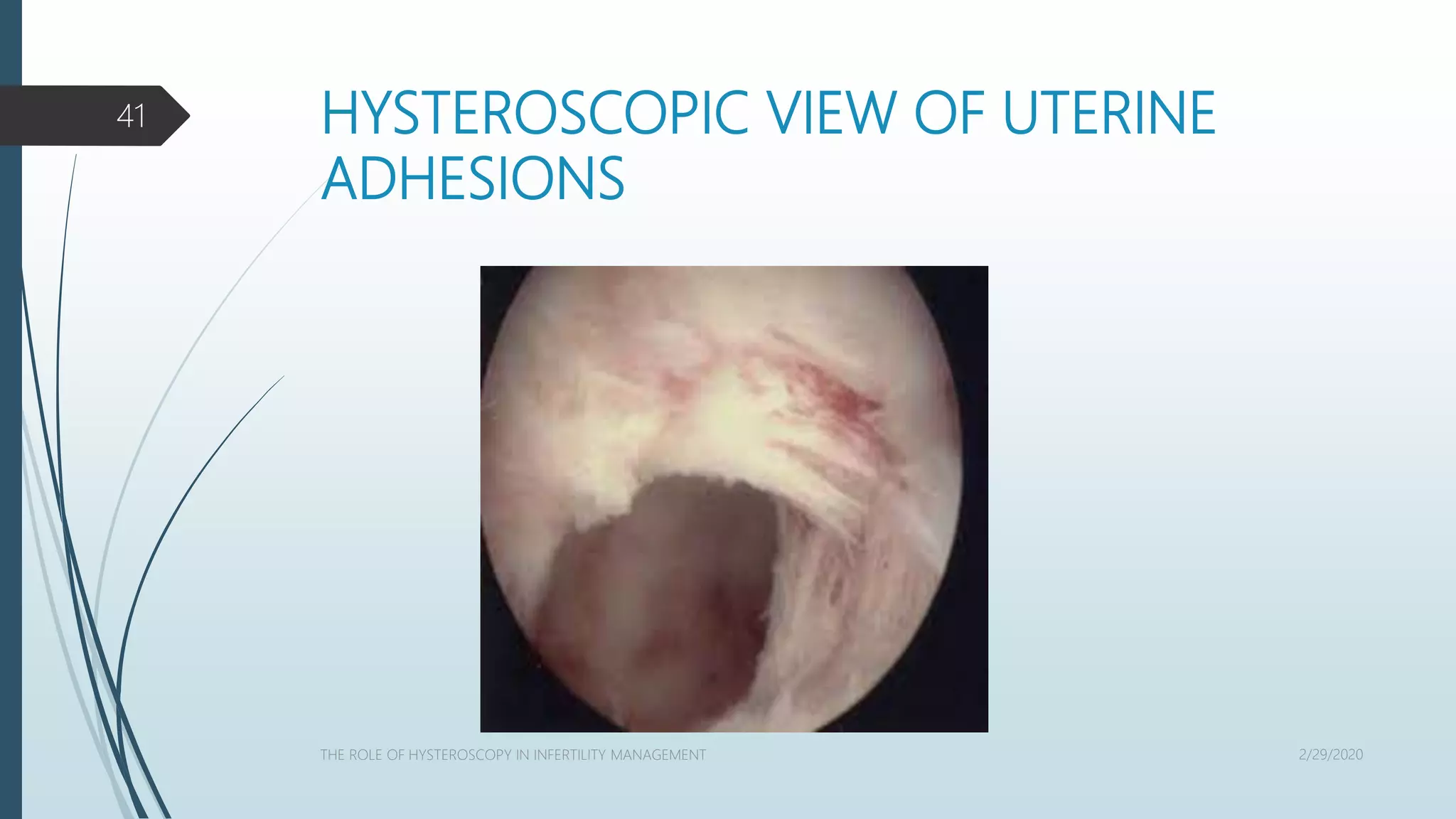 Role of hysteroscopy in infertility Management | PPTX