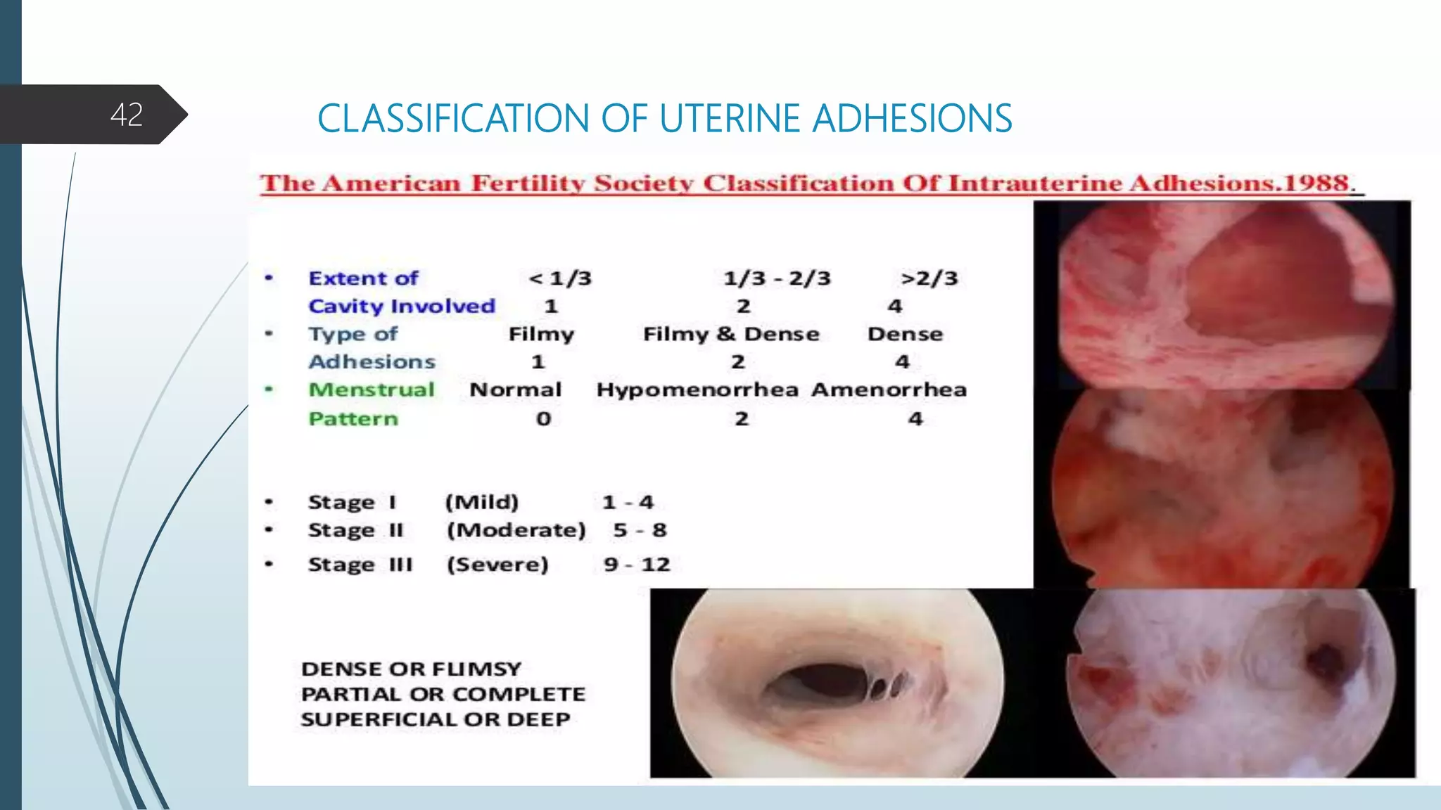 Role of hysteroscopy in infertility Management | PPTX