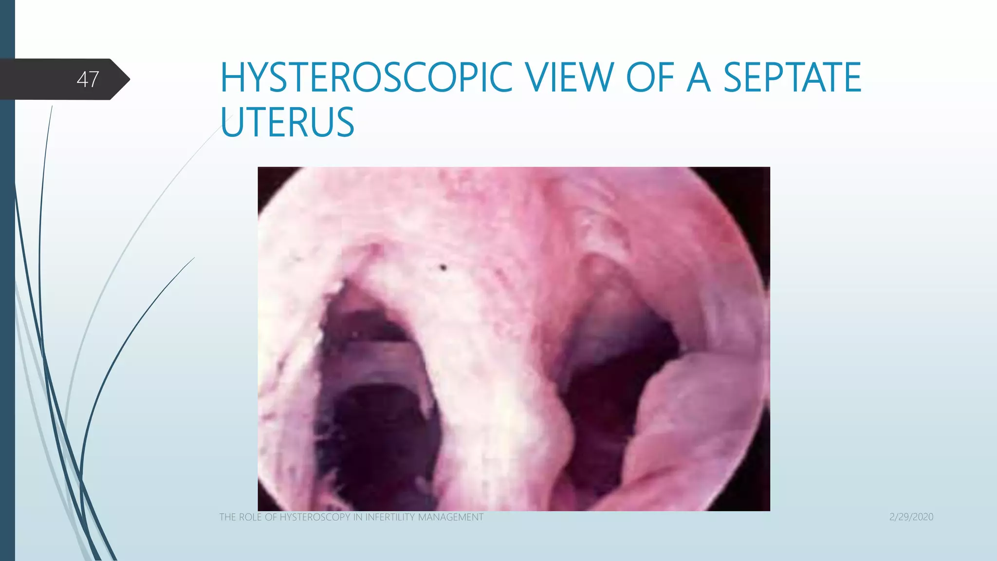 Role of hysteroscopy in infertility Management | PPT