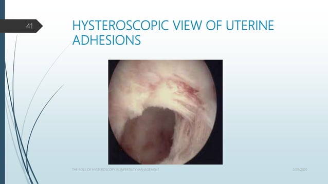 Role of hysteroscopy in infertility Management | PPT