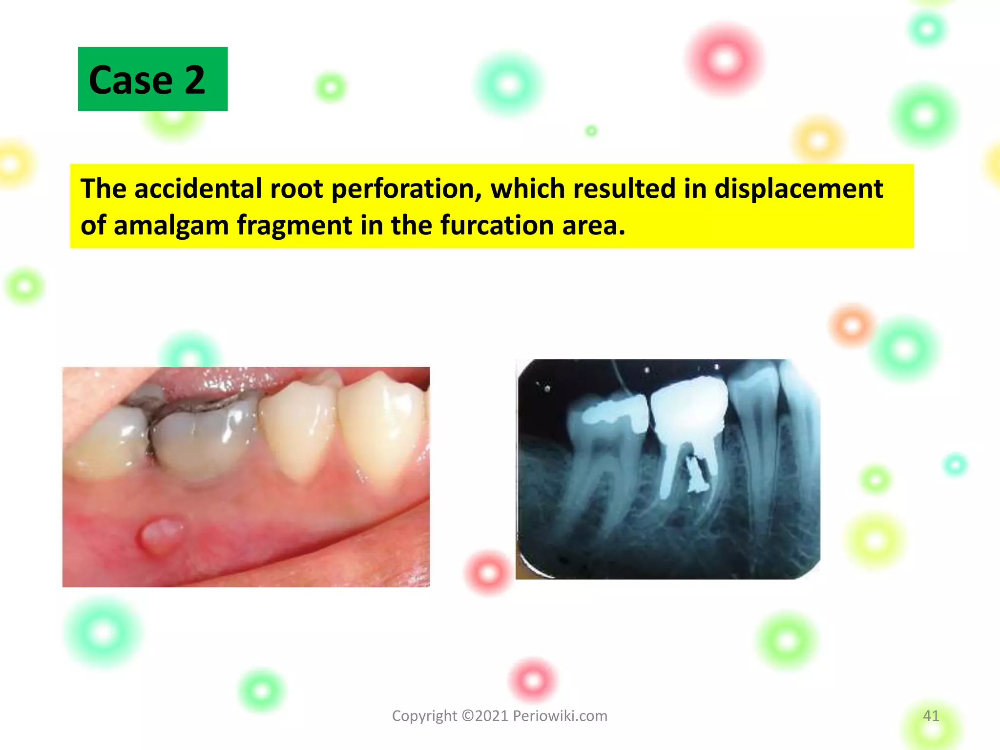 Role of iatrogenic factors in the etiology of periodontal disease | PPTX