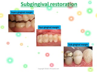 Role of iatrogenic factors in the etiology of periodontal disease | PPTX