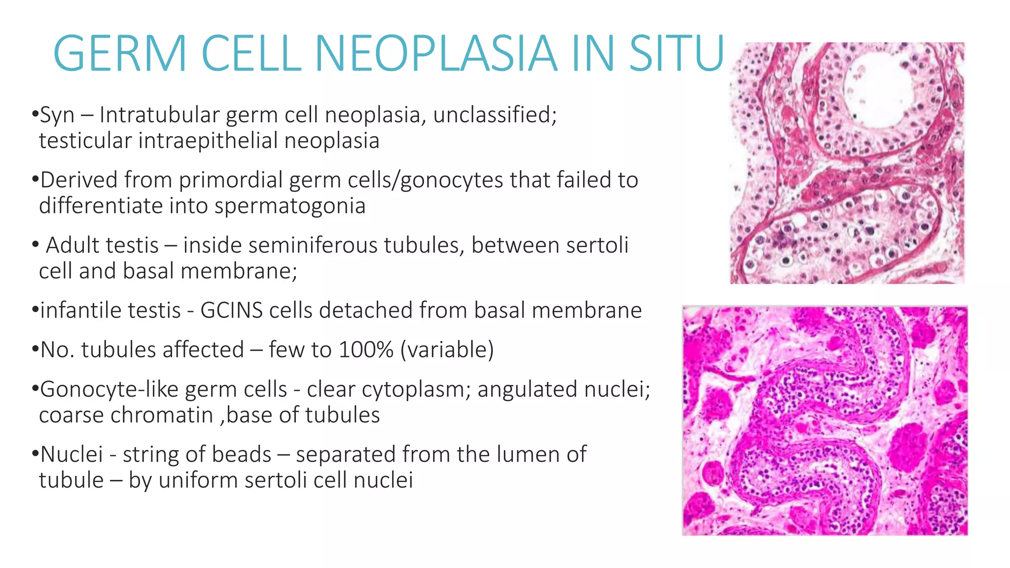 Role of ihc in testicular tumors | PPTX