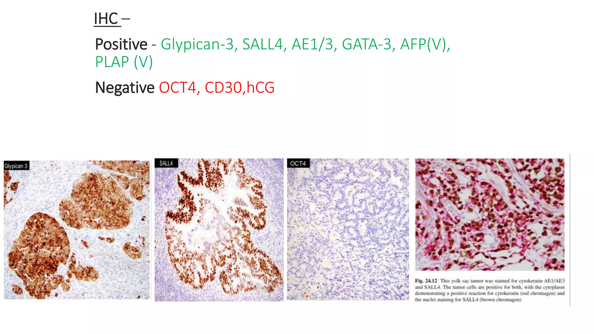 Role of ihc in testicular tumors | PPTX