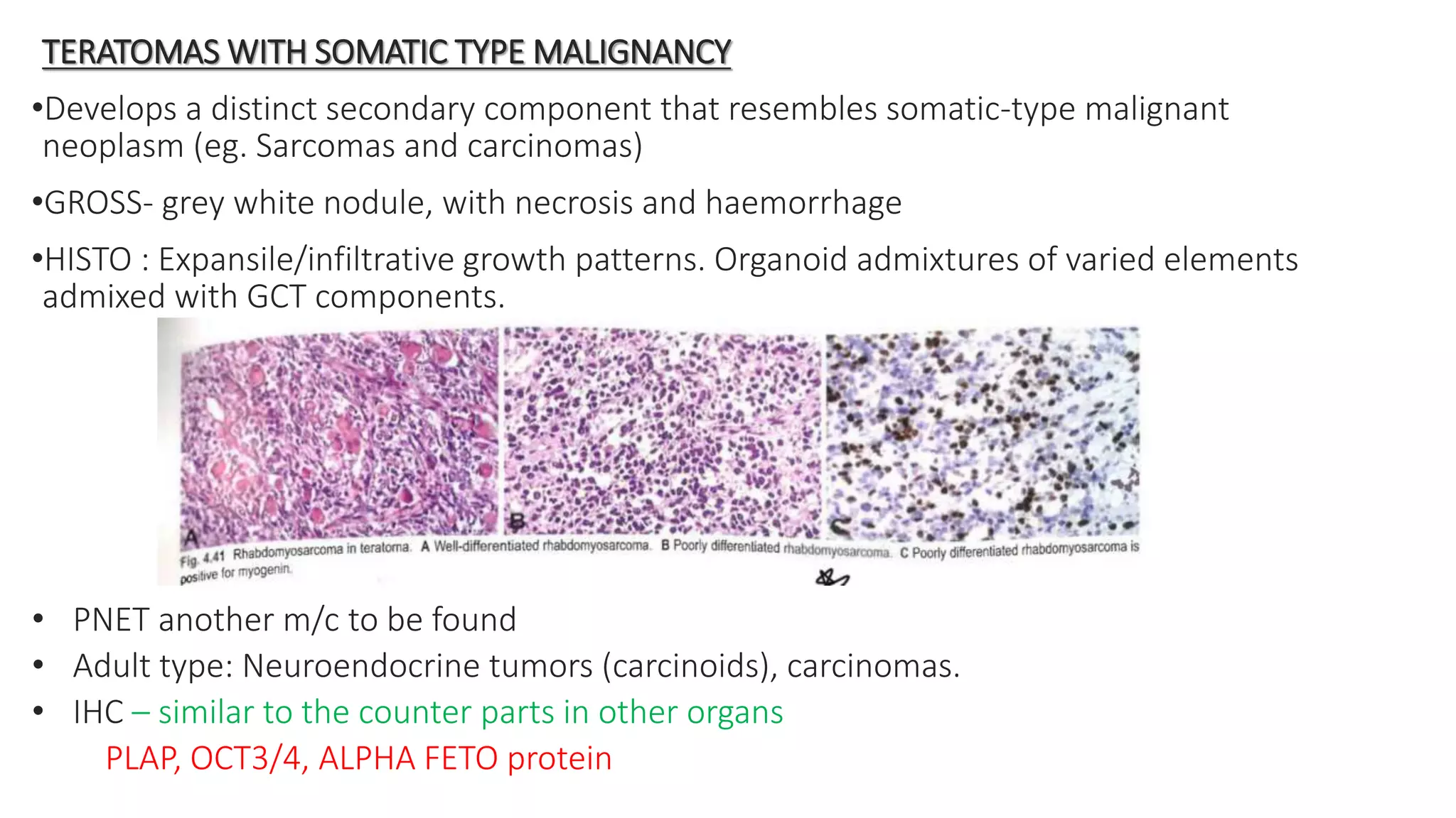 Role of ihc in testicular tumors | PPTX
