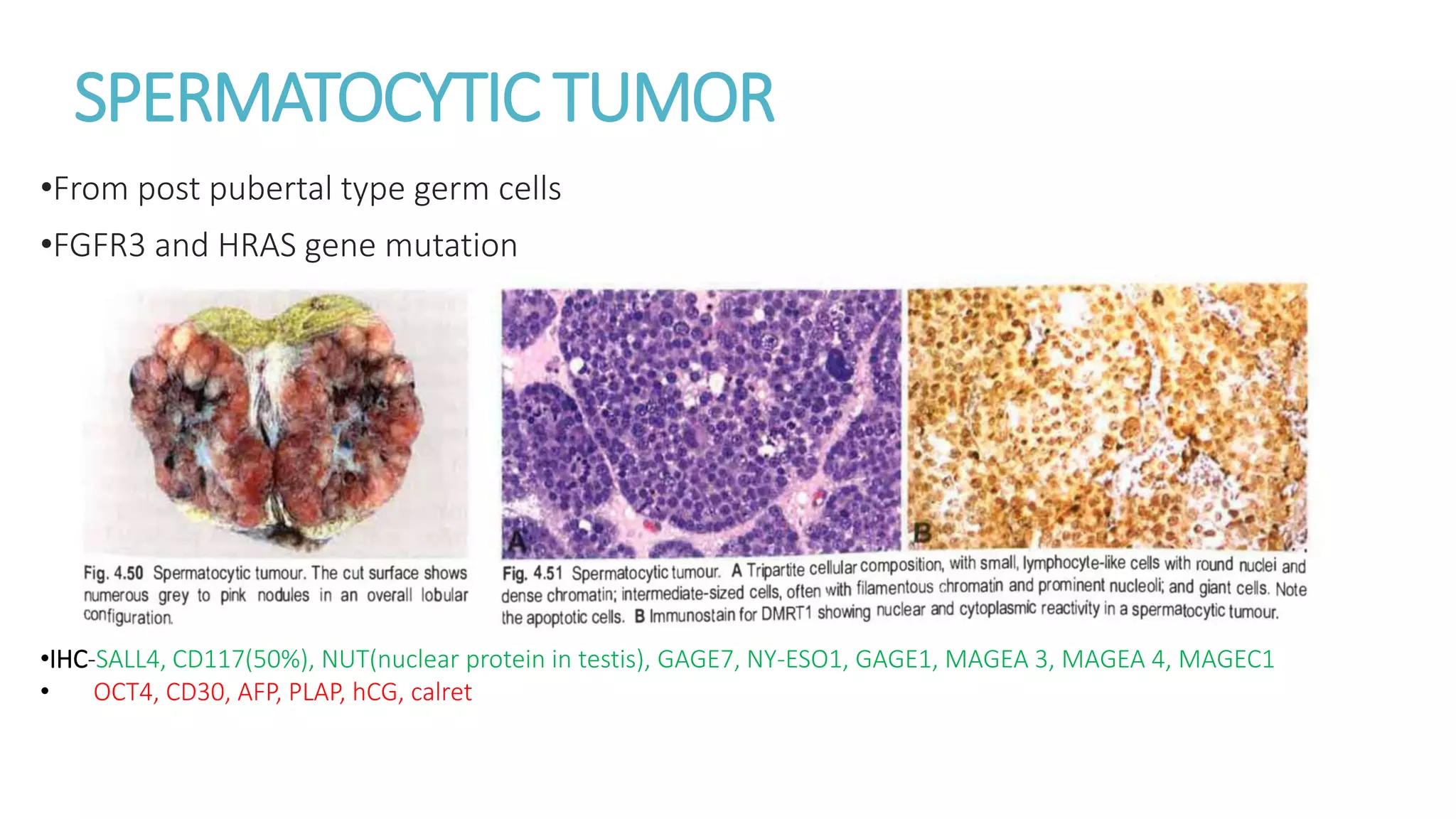 Role of ihc in testicular tumors | PPTX