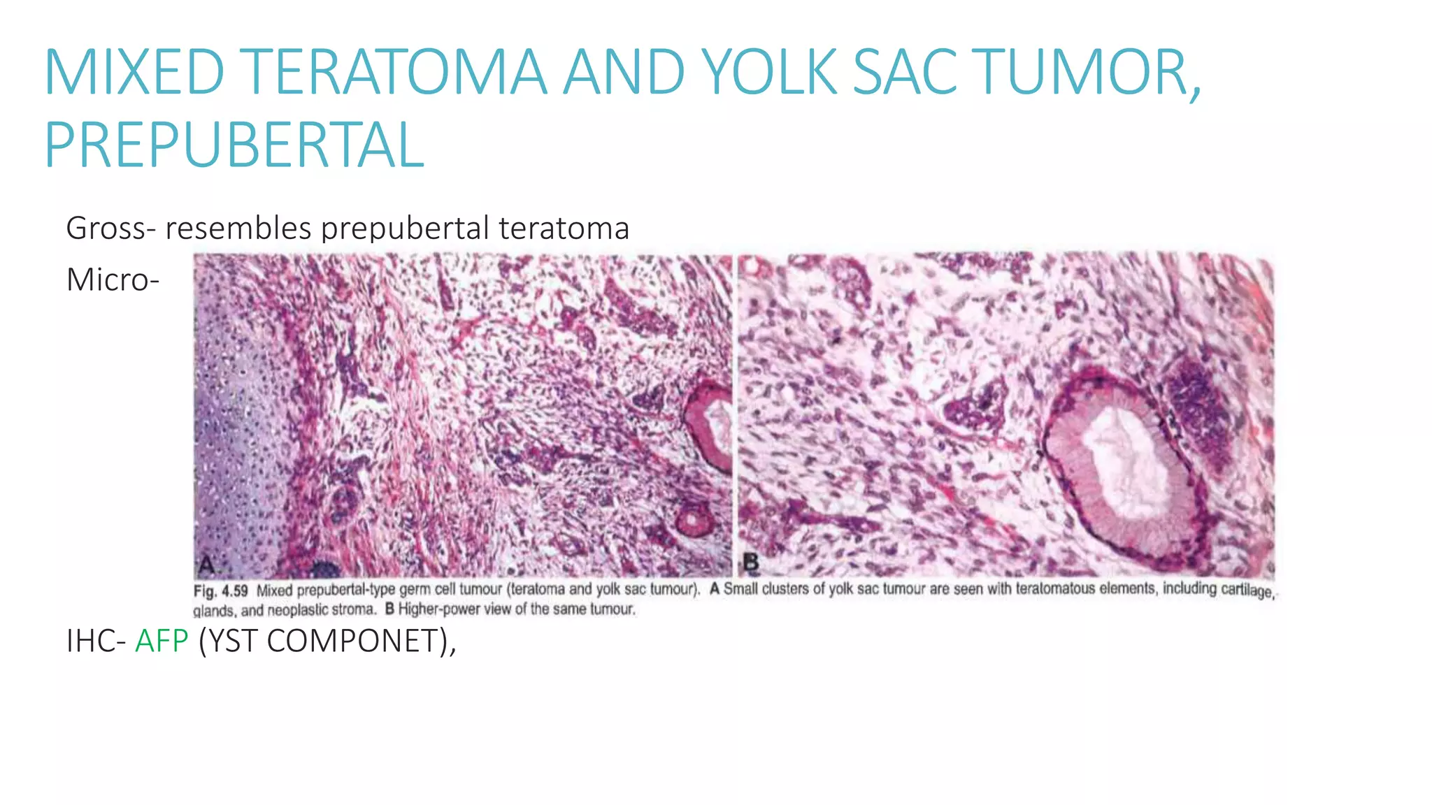Role of ihc in testicular tumors | PPTX