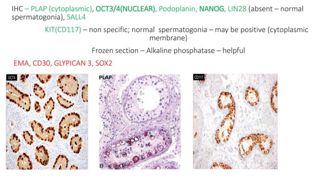 Role of ihc in testicular tumors | PPTX | Cancer | Diseases and Conditions