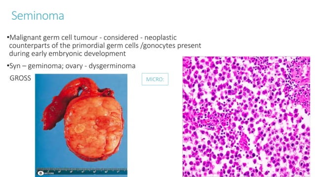 Role of ihc in testicular tumors | PPTX | Cancer | Diseases and Conditions