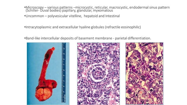 Role of ihc in testicular tumors | PPTX | Cancer | Diseases and Conditions