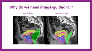 Role of Image Guidance in Radiotherapy | PPTX