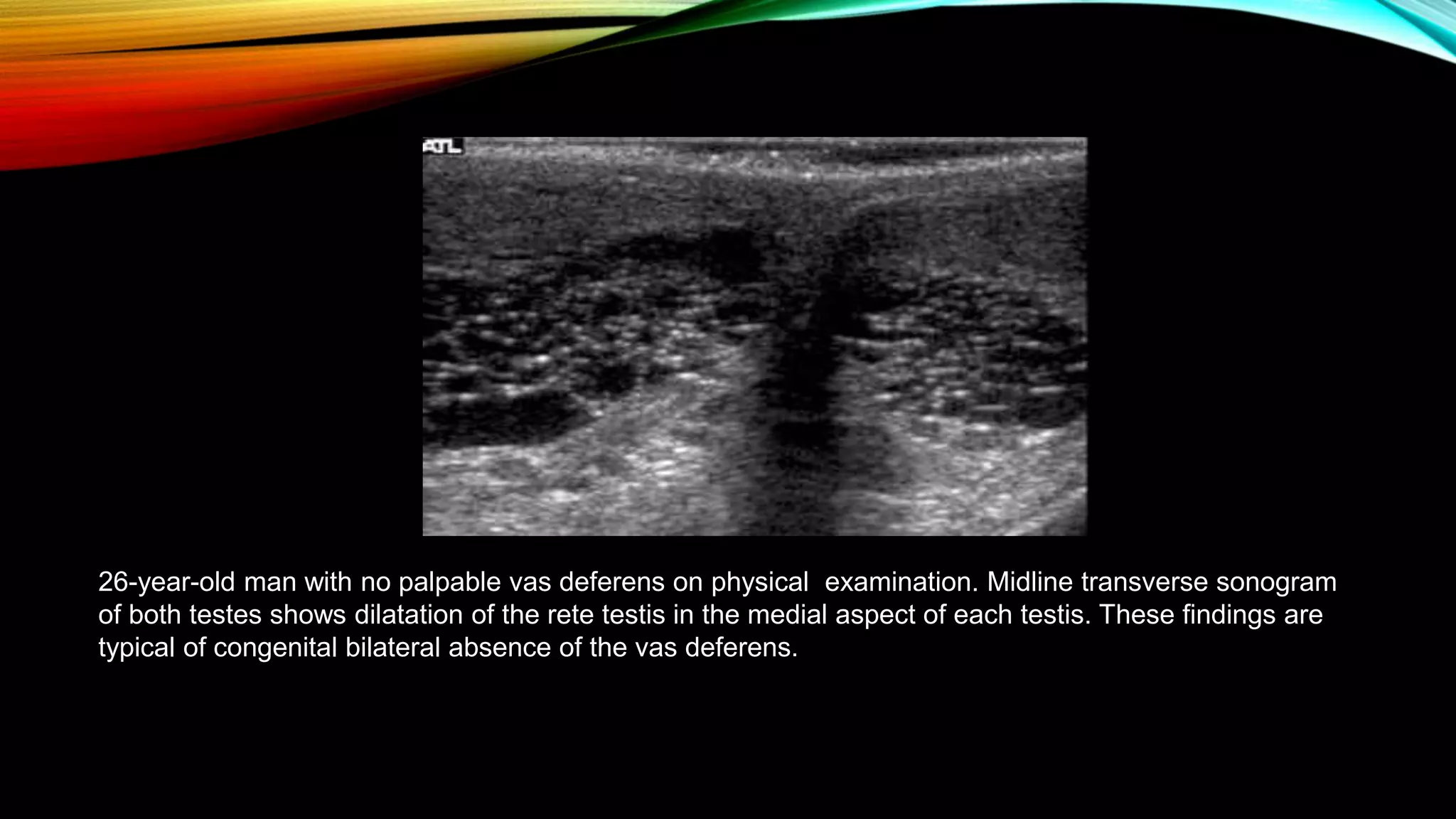 Role of Imaging in Male Infertility | PPTX