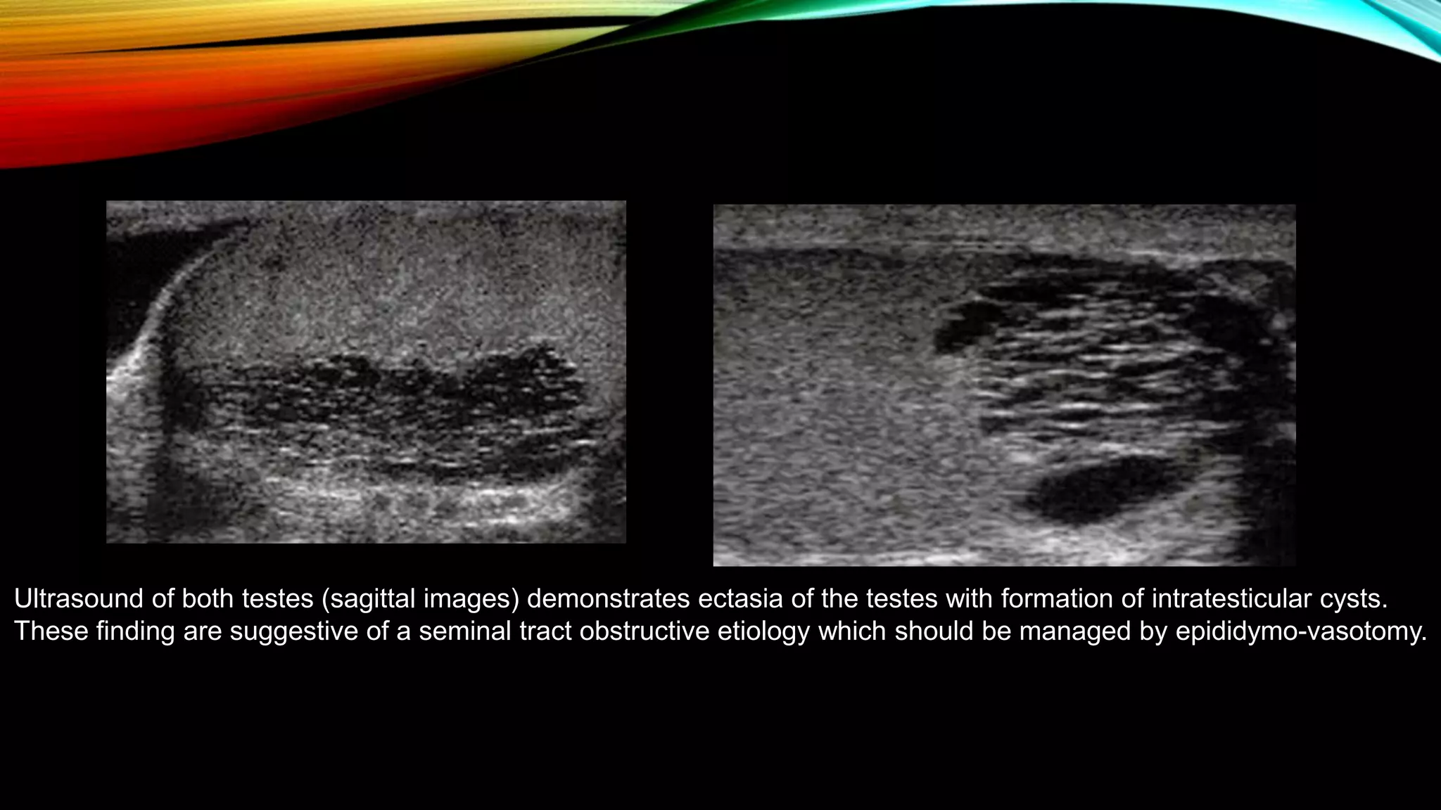 Role of Imaging in Male Infertility | PPTX
