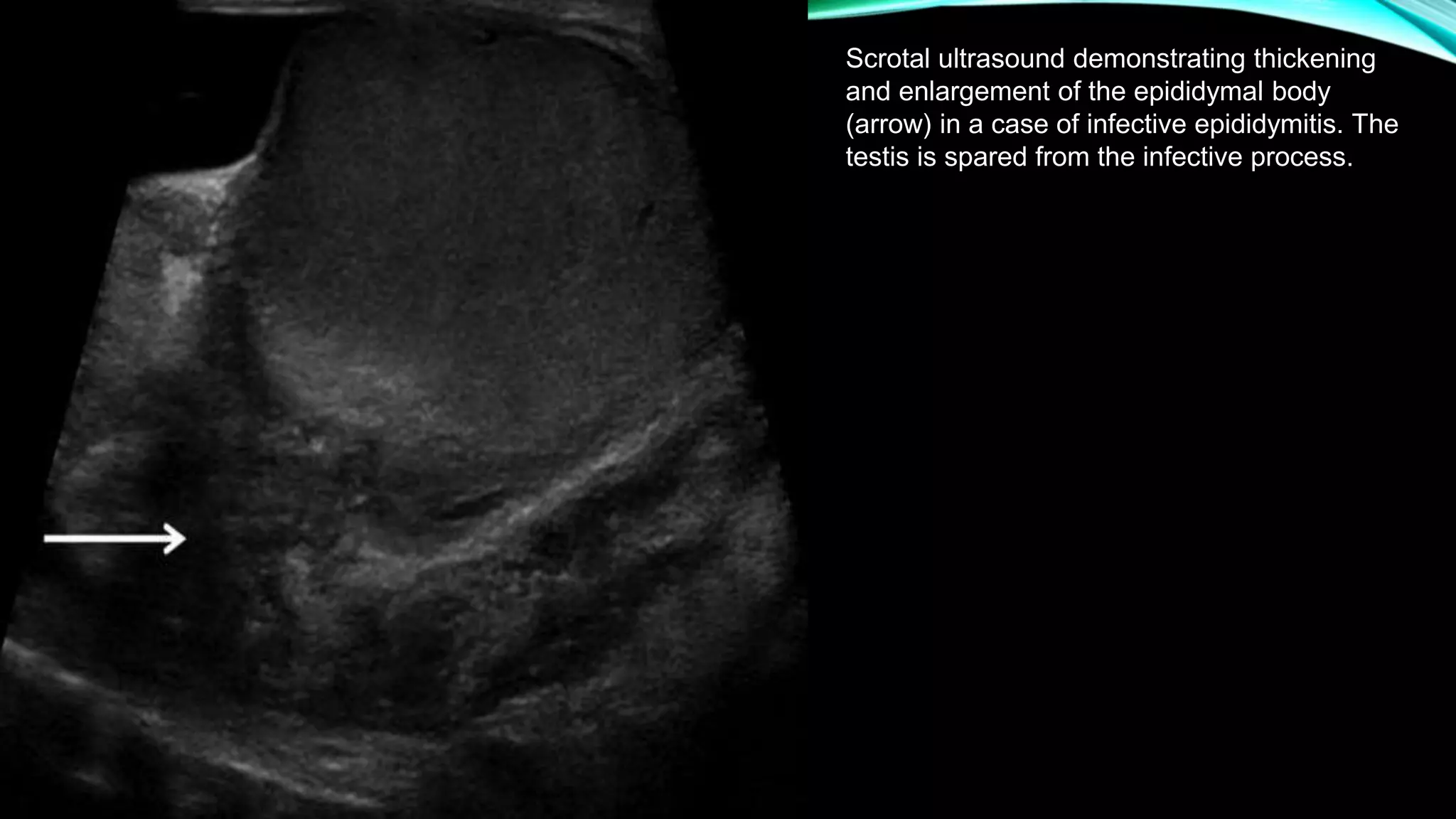 Role of Imaging in Male Infertility | PPTX