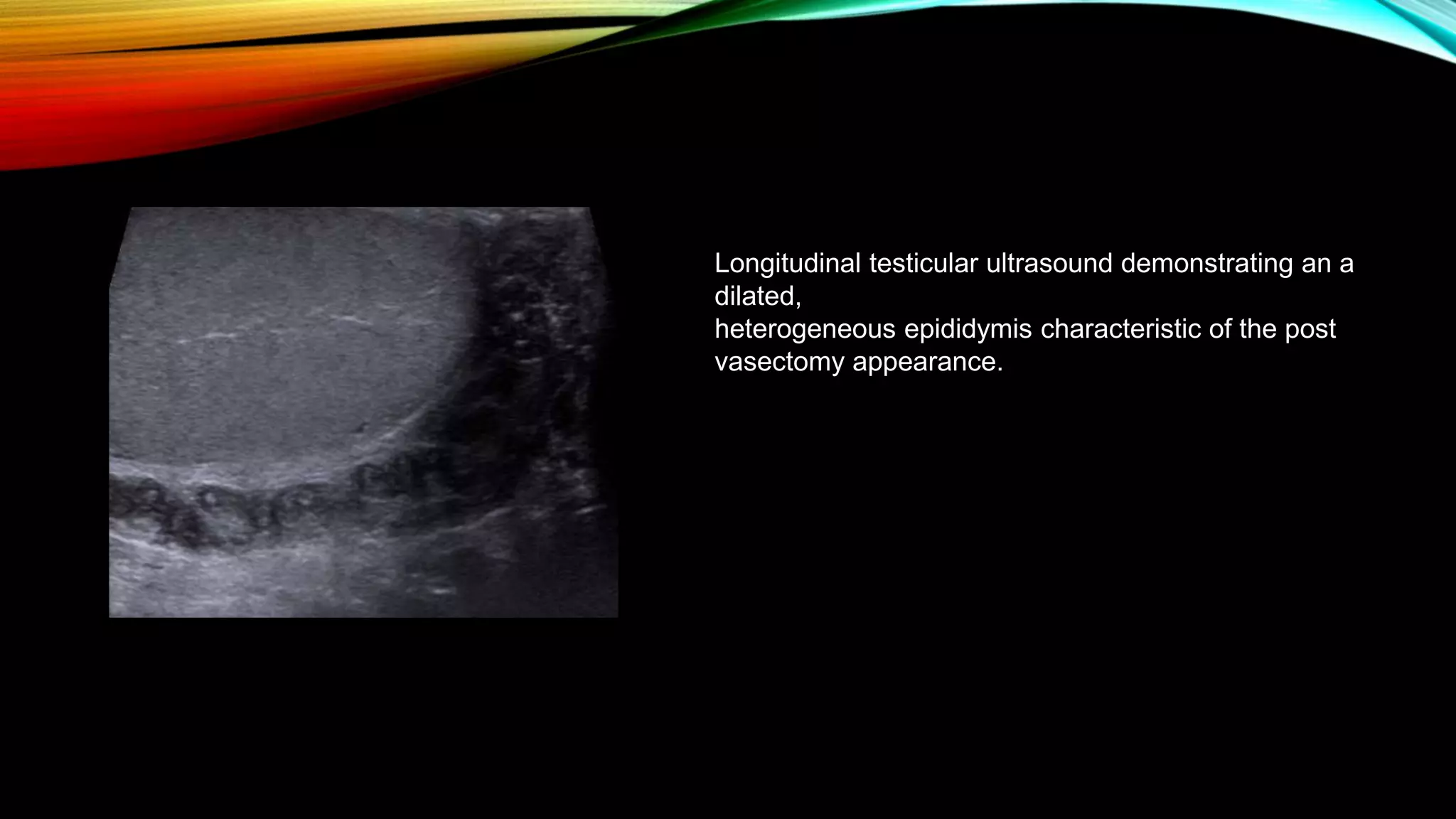 Role of Imaging in Male Infertility | PPTX