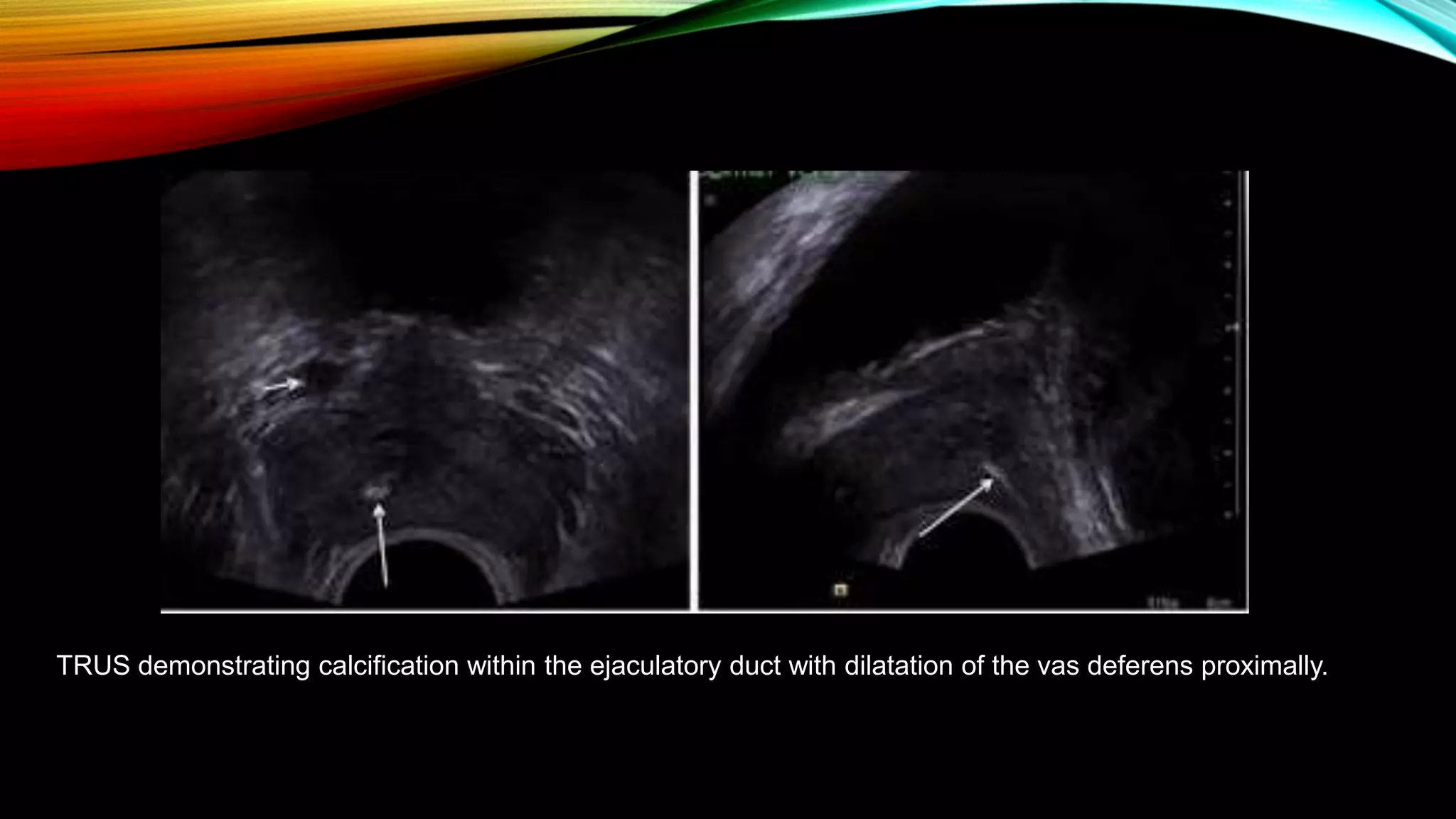 Role of Imaging in Male Infertility | PPTX