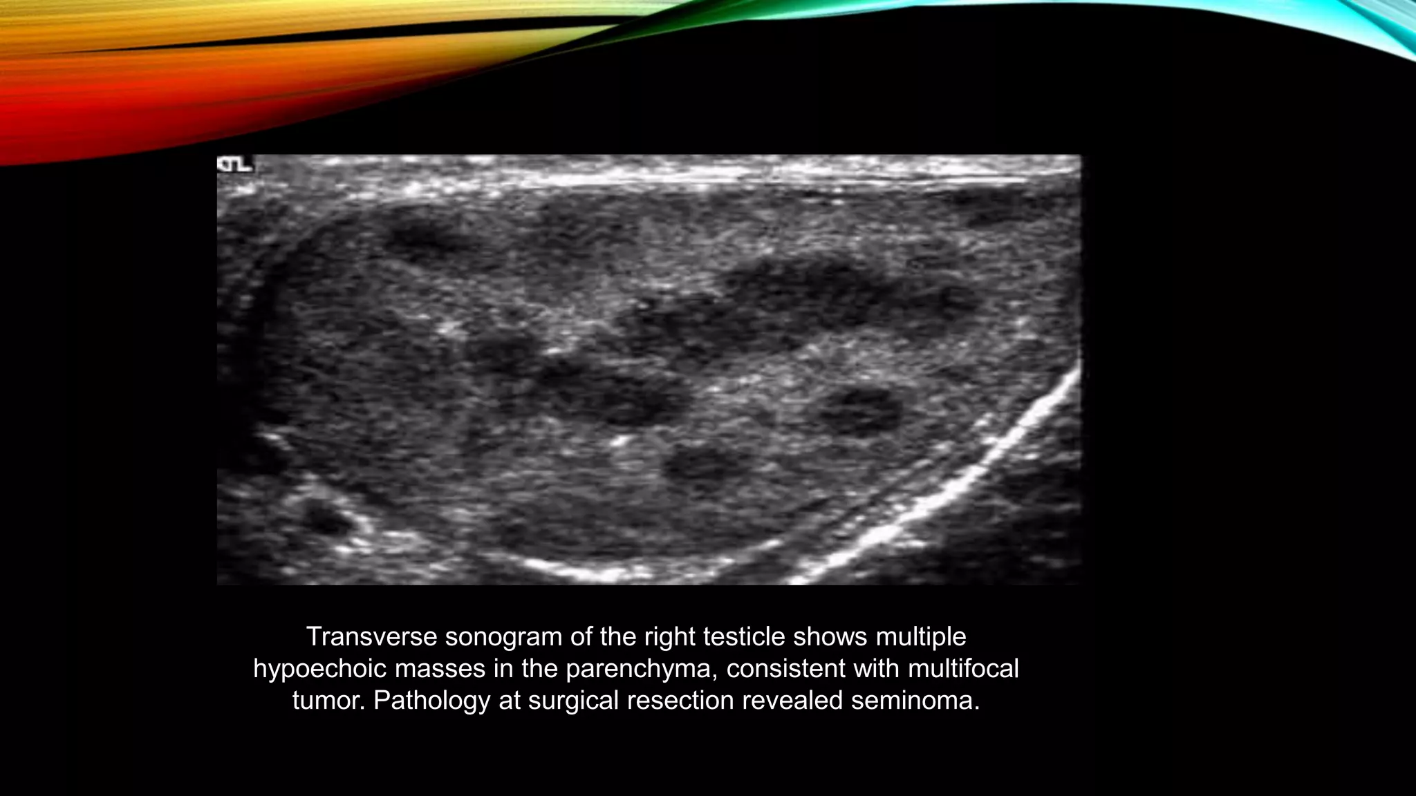 Role of Imaging in Male Infertility | PPTX