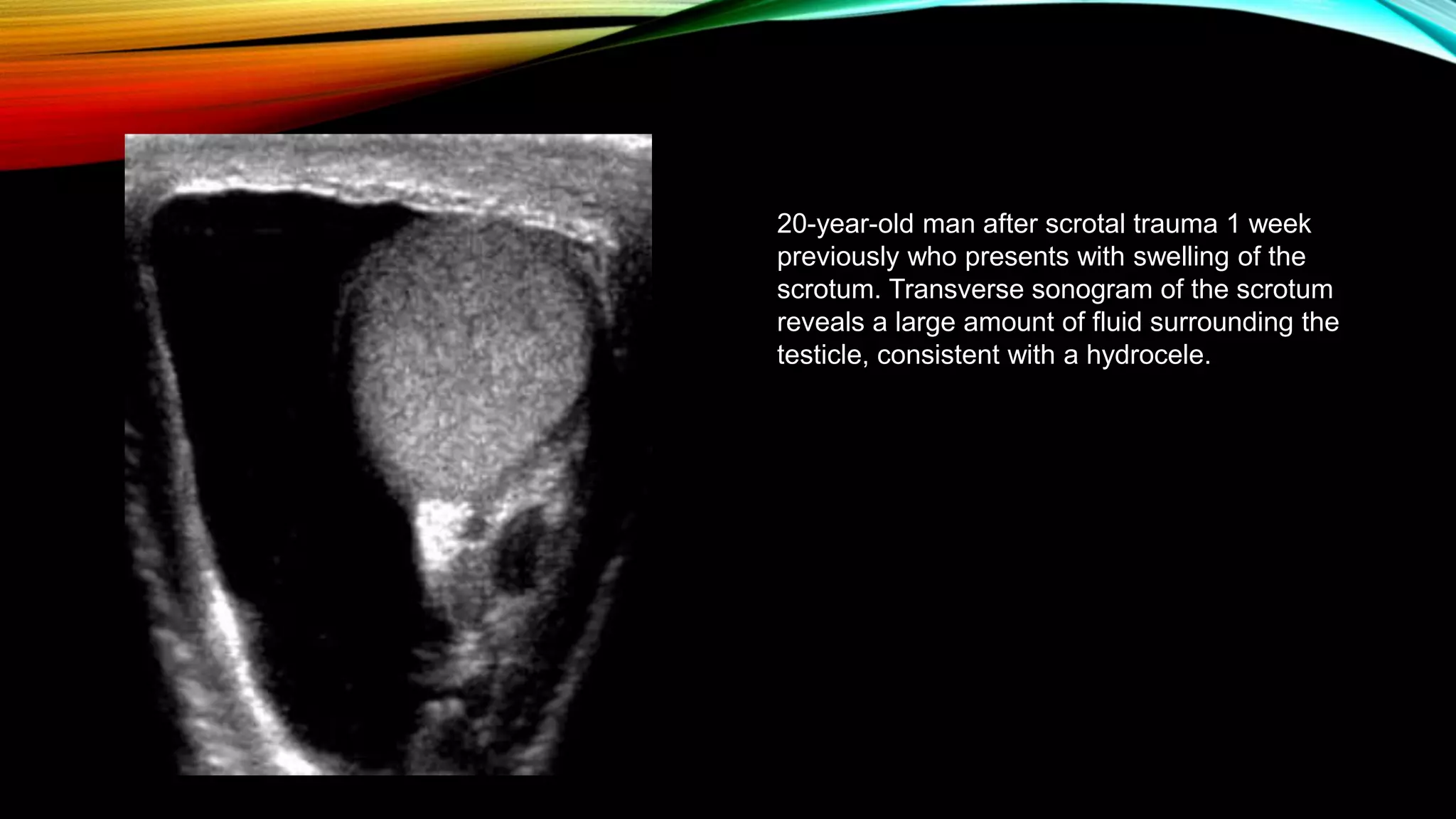 Role of Imaging in Male Infertility | PPTX