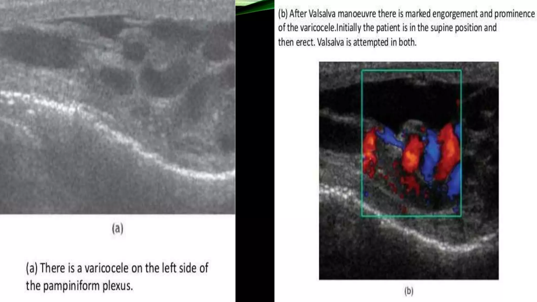 Role of Imaging in Male Infertility | PPTX