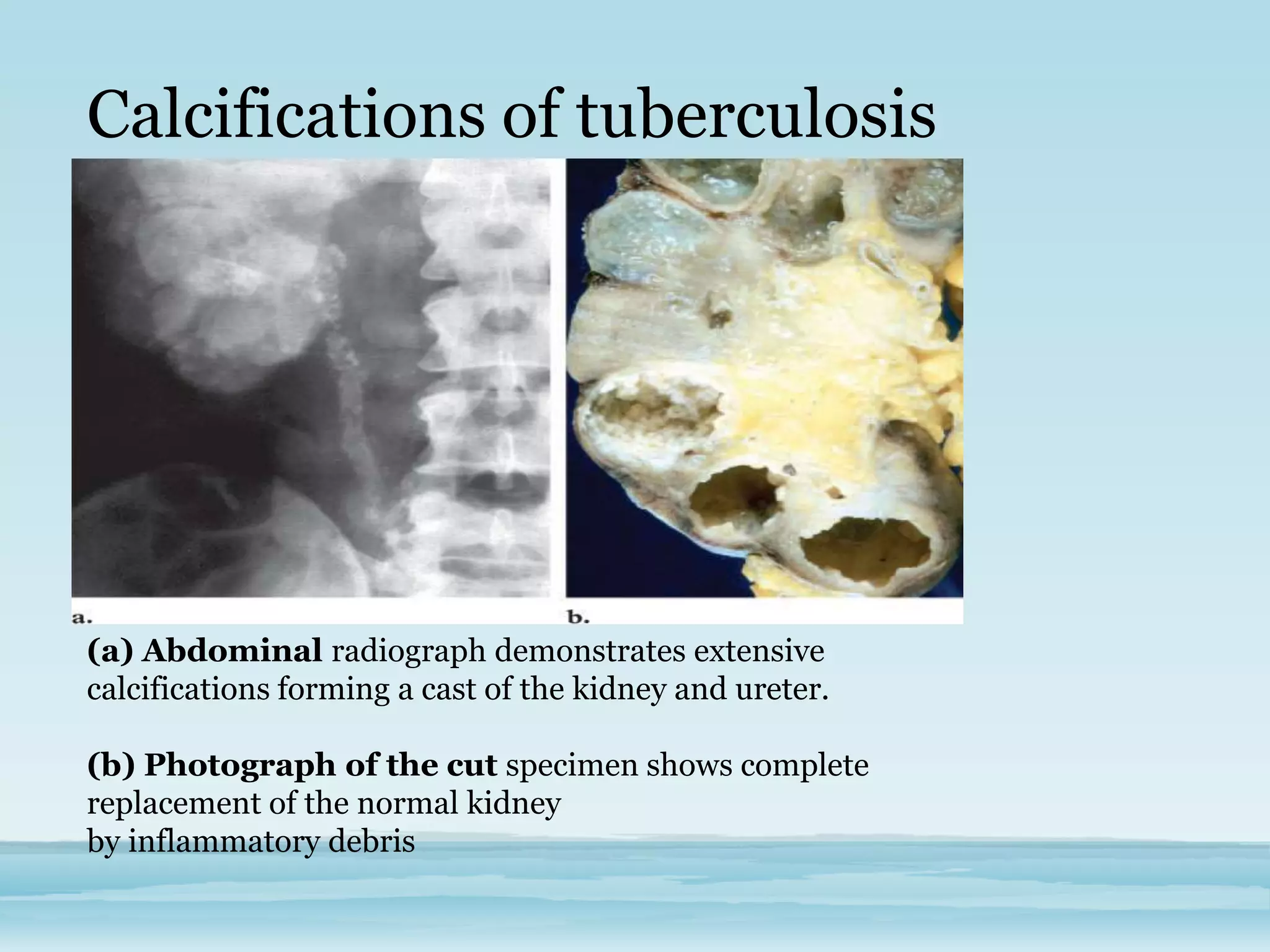 Role of imaging in renal tuberculosis | PPTX